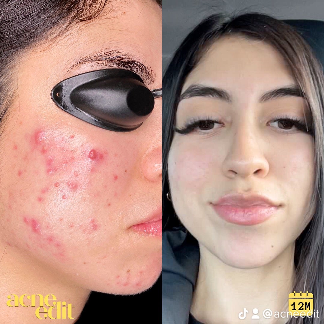 Acne Edit Program | Acne Edit