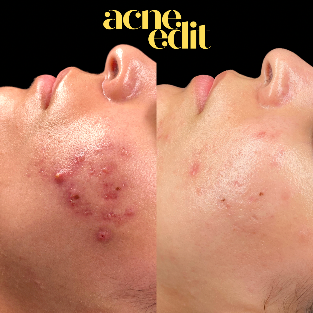 Leading Acne Expert | Acne Edit