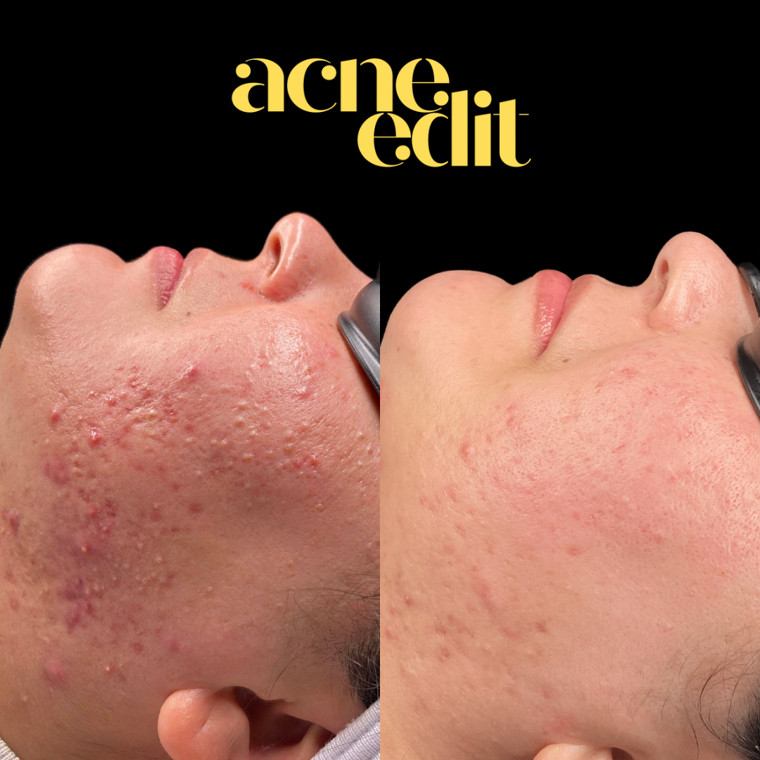 Leading Acne Expert | Acne Edit