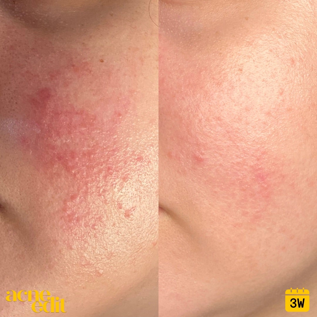 Leading Acne Expert | Acne Edit